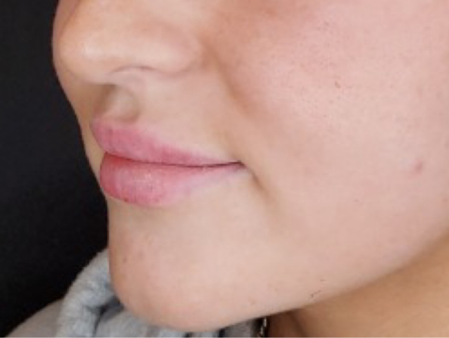 Avant et après - Clinique Rejuvena - Médico-esthétique et Phlébologie